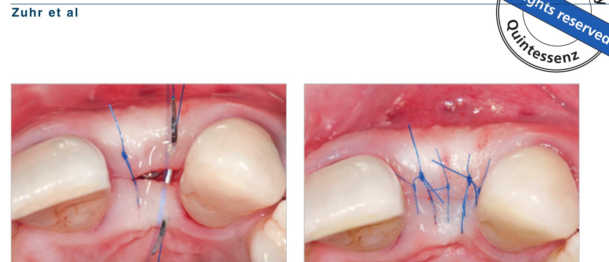 Figure 8 - Wound closure and wound healing. Suture
