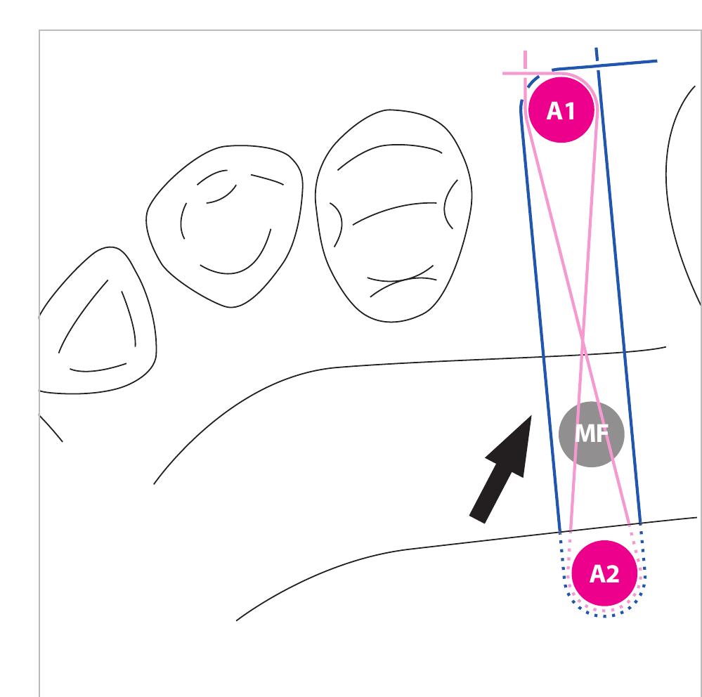 Figure 11 - from Wound closure and wound healing. Suture
