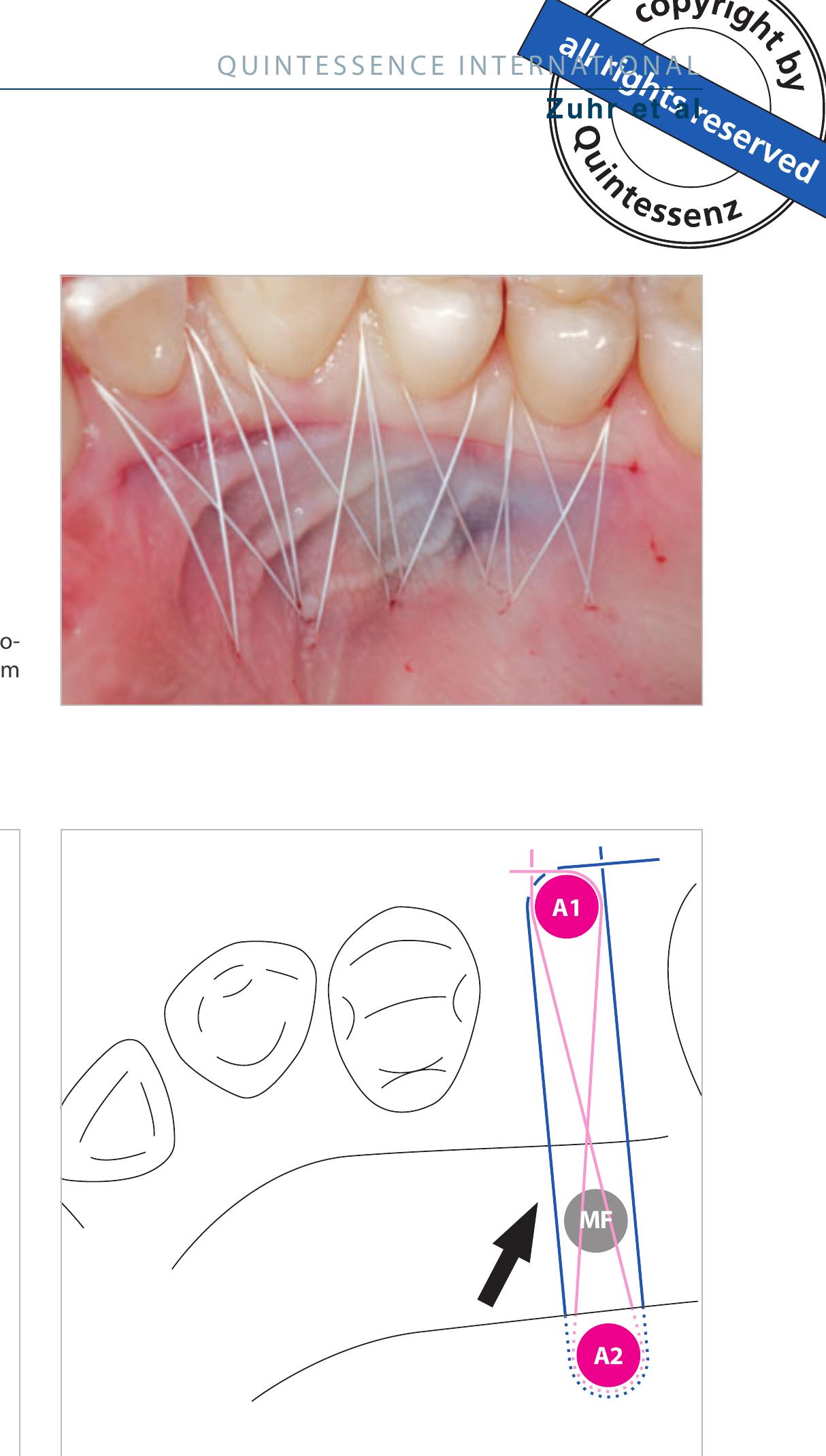 Figure 12 - Wound closure and wound healing. Suture