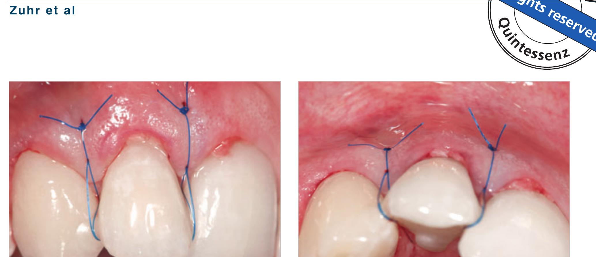 Figure 16 - Wound closure and wound healing. Suture
