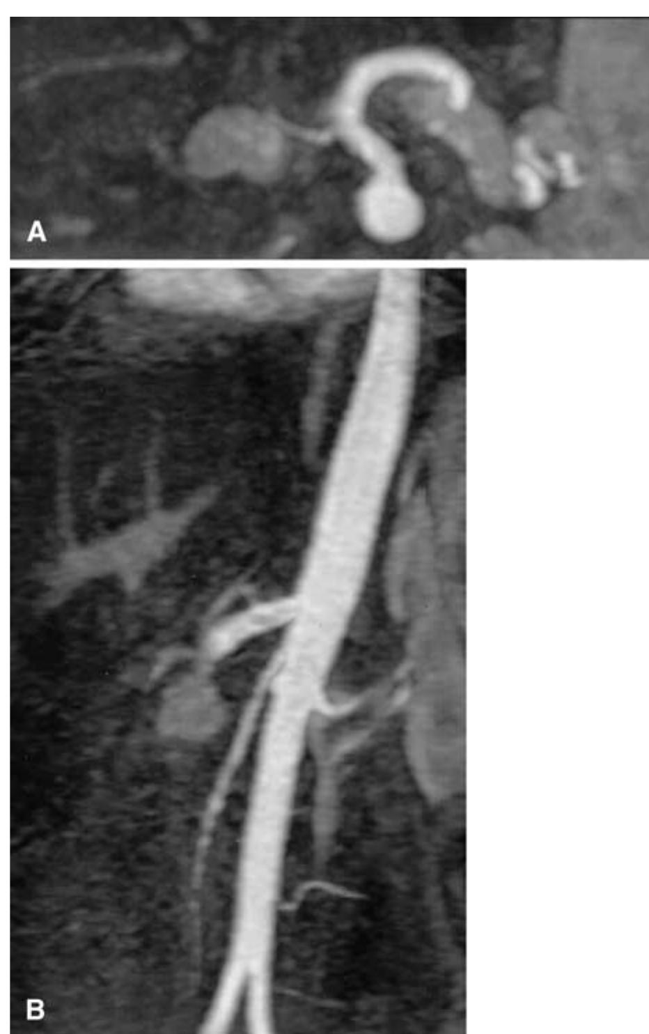 Hepatic artery thrombosis. a axial and b coronal oblique