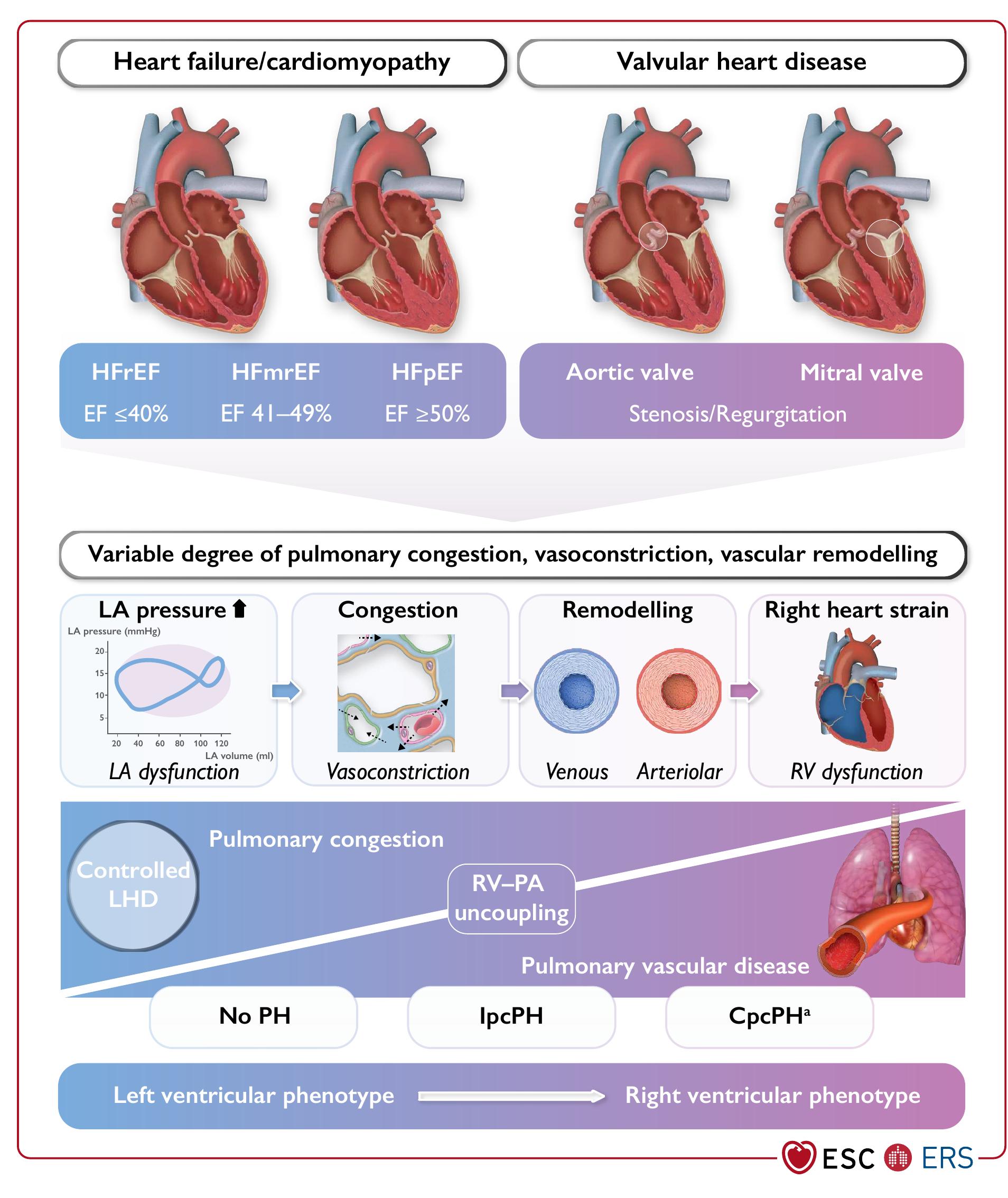 Pathophysiology of pulmonary hypertension associated with