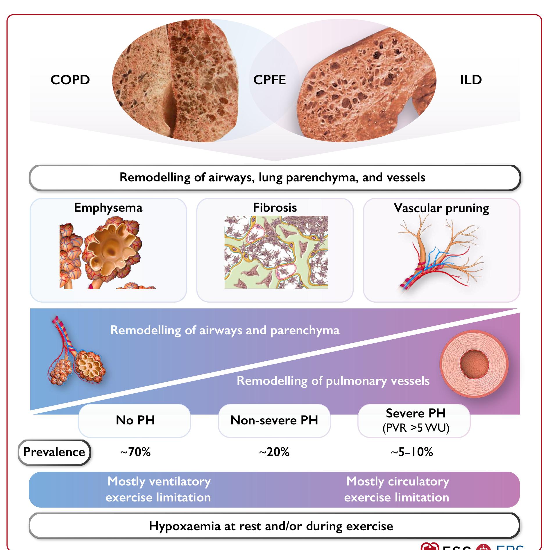 Pathophysiology of pulmonary hypertension associated with