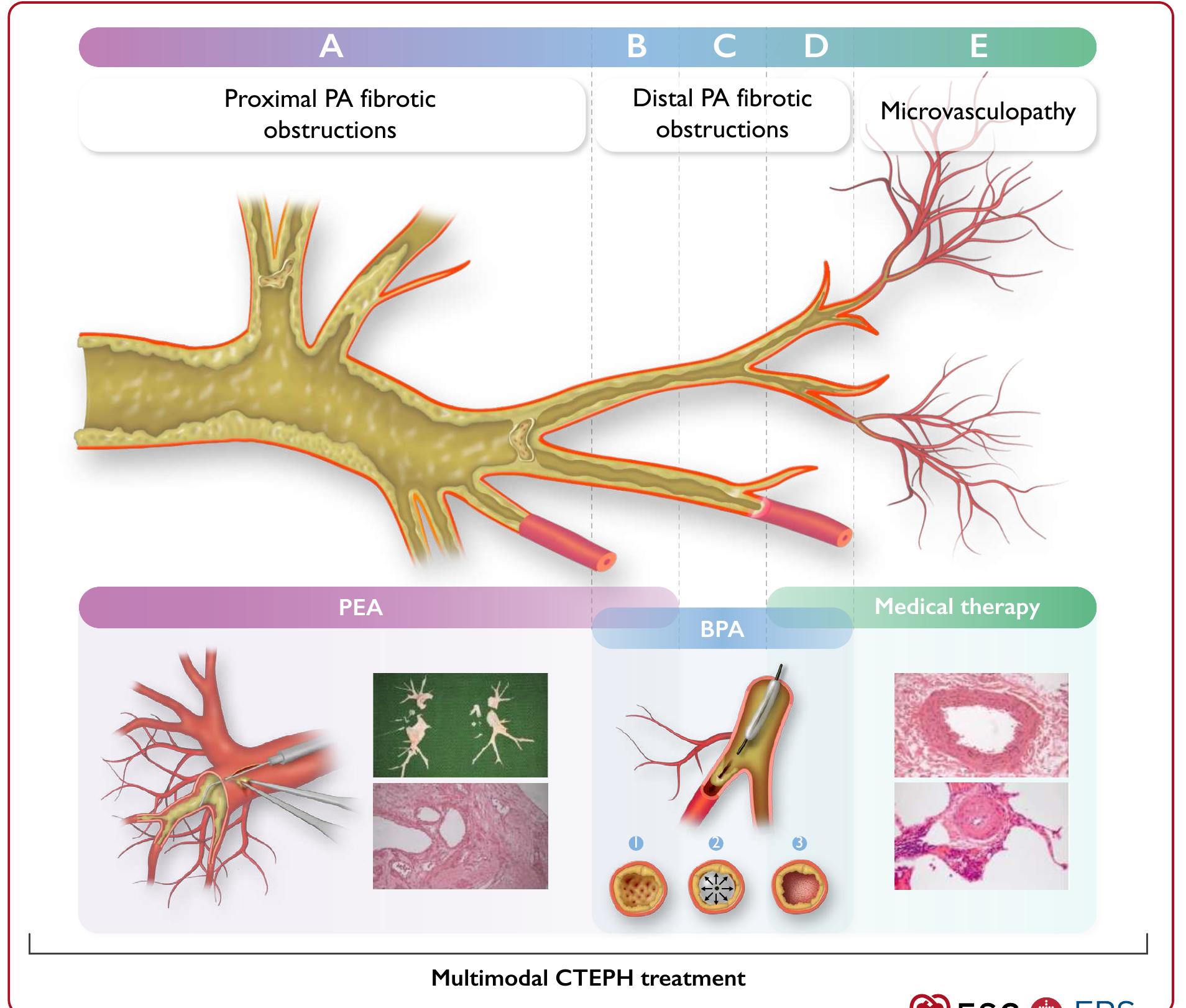(PDF) 2022 ESC/ERS Guidelines for the diagnosis and treatment of ...