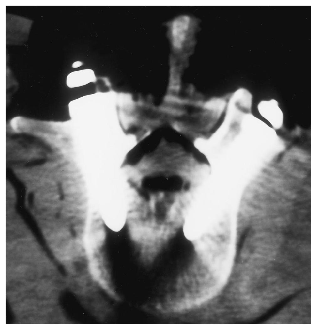 Postoperative axial ct scan performed through the t12