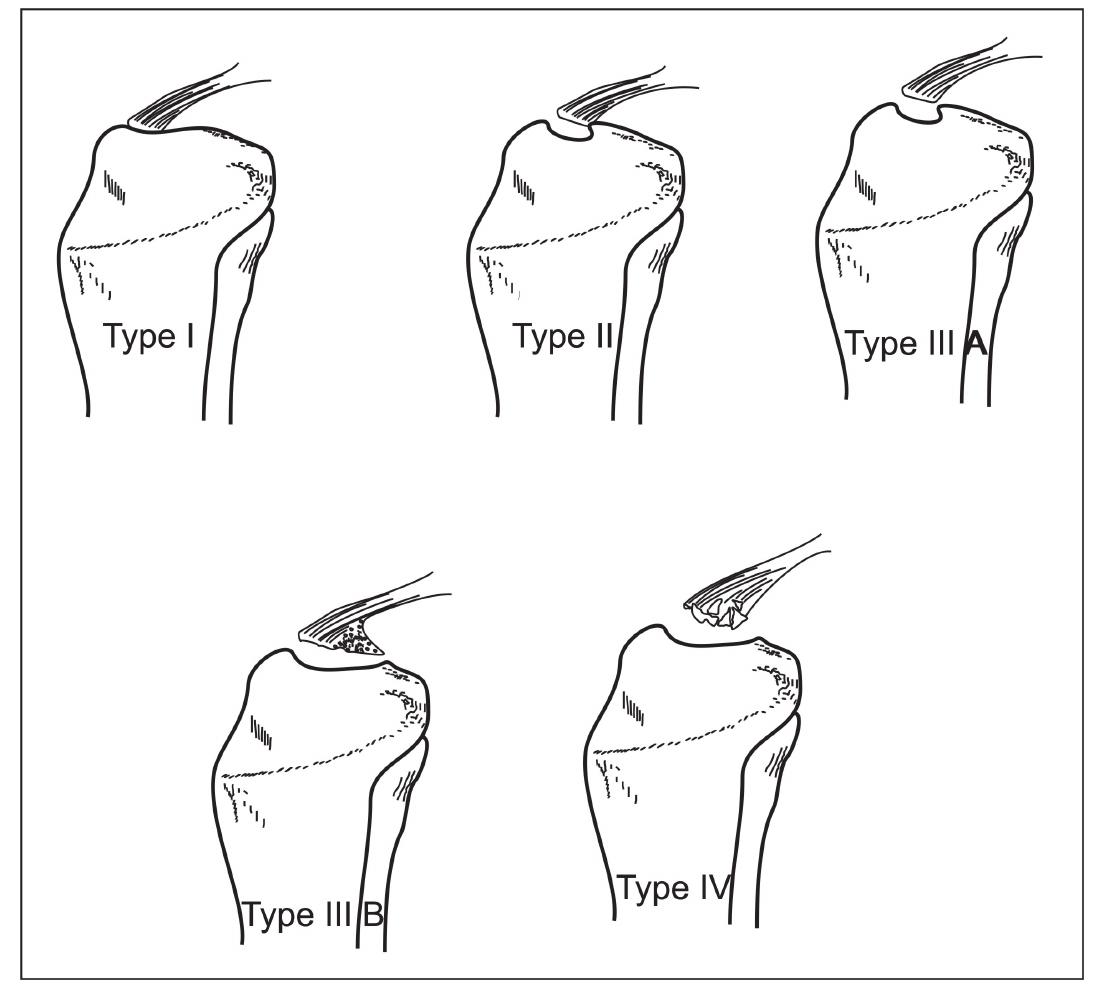Mayer and mc keevers classification of tibial spine avulsion
