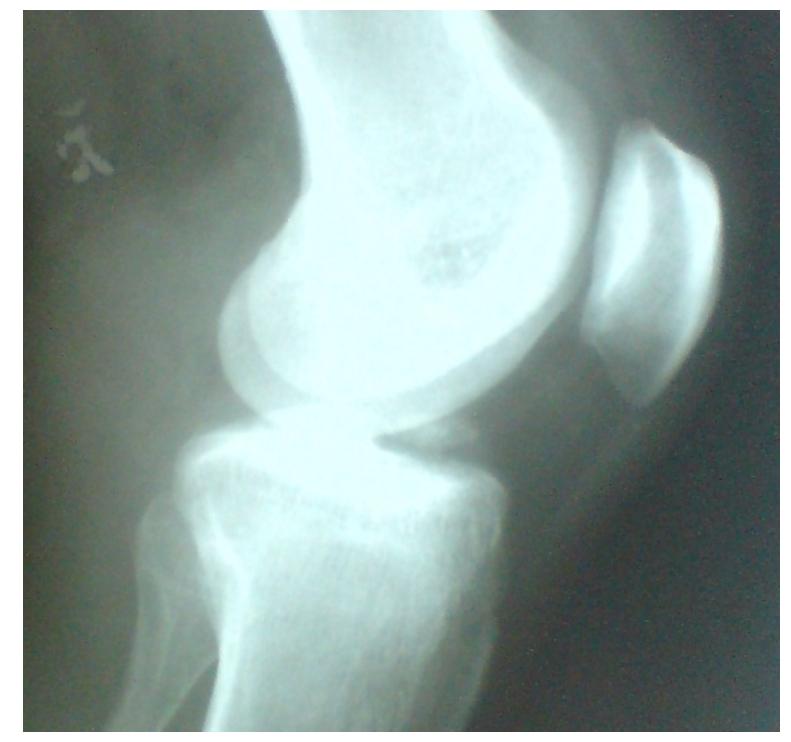 Lateral view of tibial spine avulsion fracture in mature