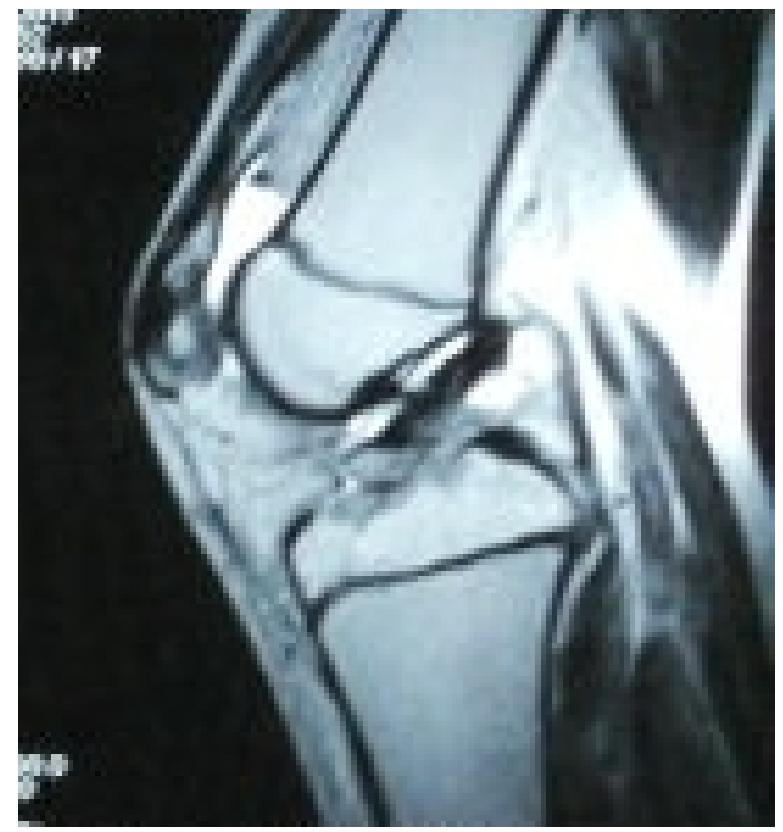 Mri of knee showing tibial spine avulsion fracture in