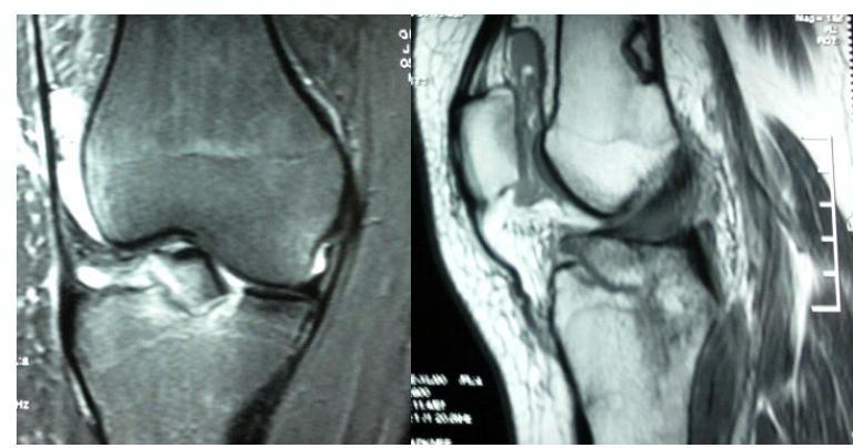 Mri of knee showing tibial spine avulsion fracture in mature
