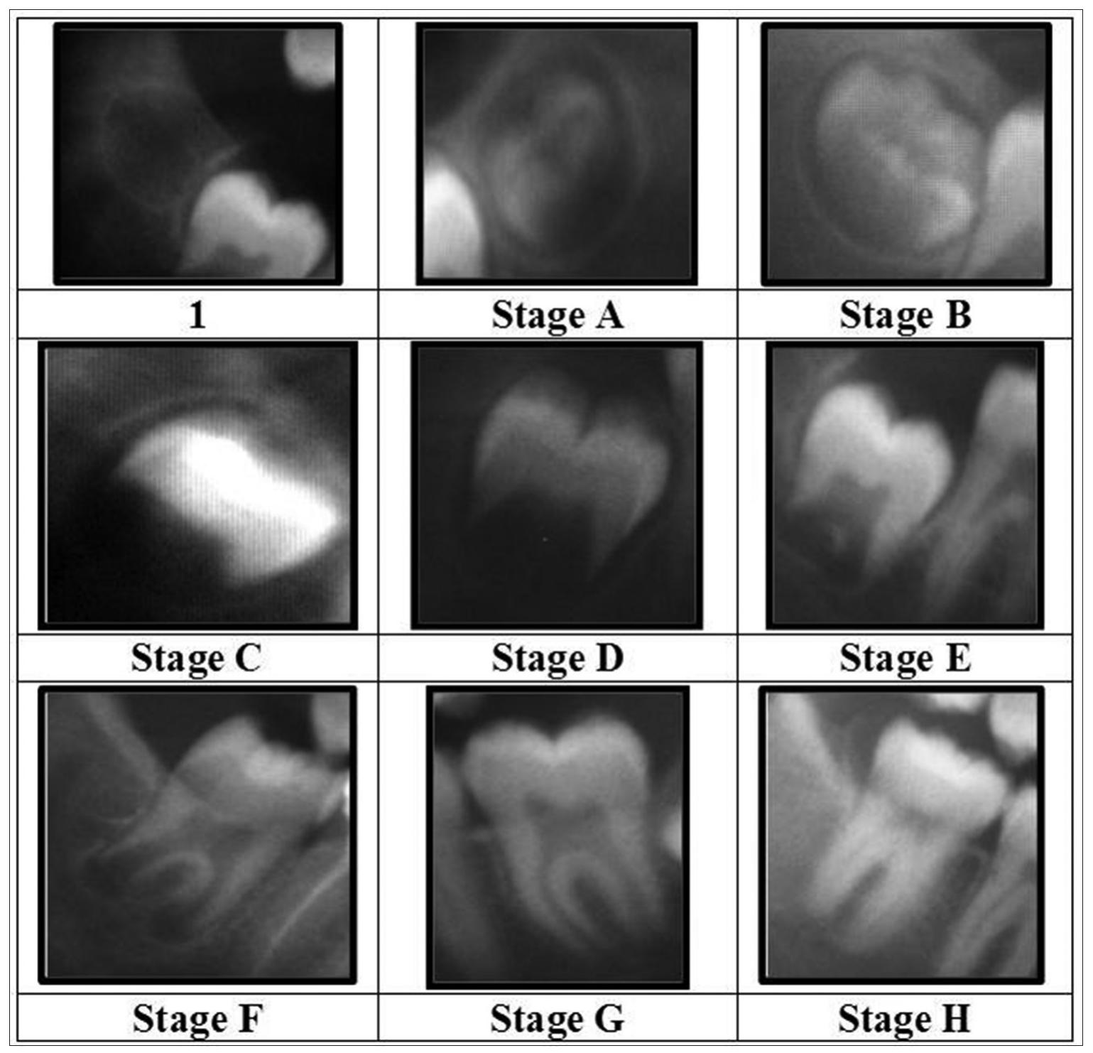 Stages of third molar mineralization the third molar