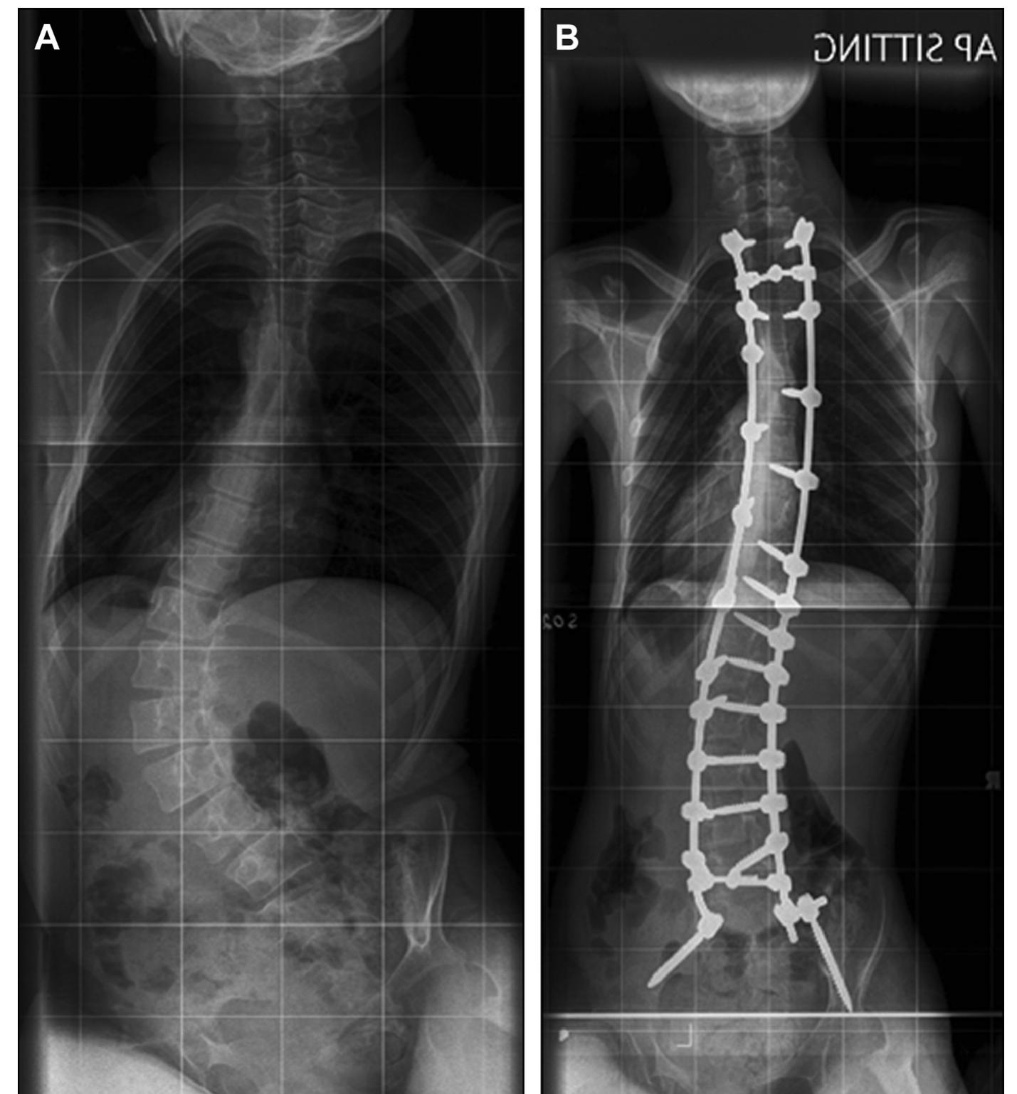 Sitting radiographs of a 13-year-old boy with scoliosis