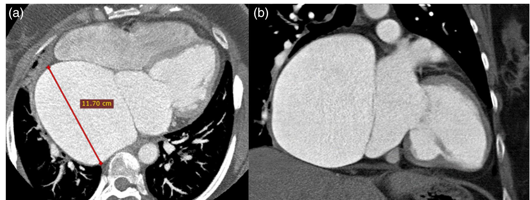 Cardiac ct-scan: 4-chamber view (a) and 2-chamber view (b).
