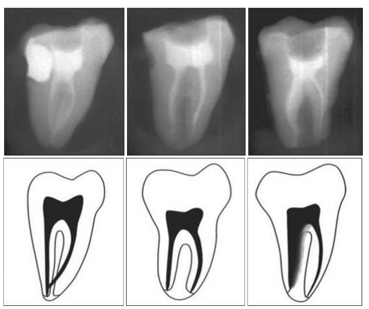 Figure 8 - C-Shaped Canals: A Review