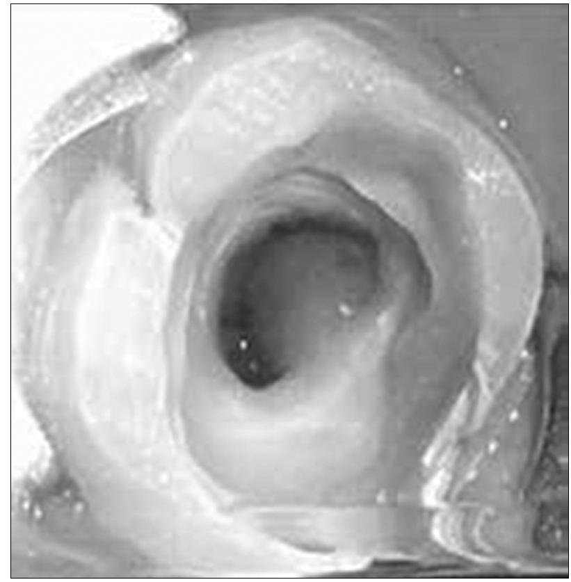 Access cavity of a c-shaped mandibular second molar. the