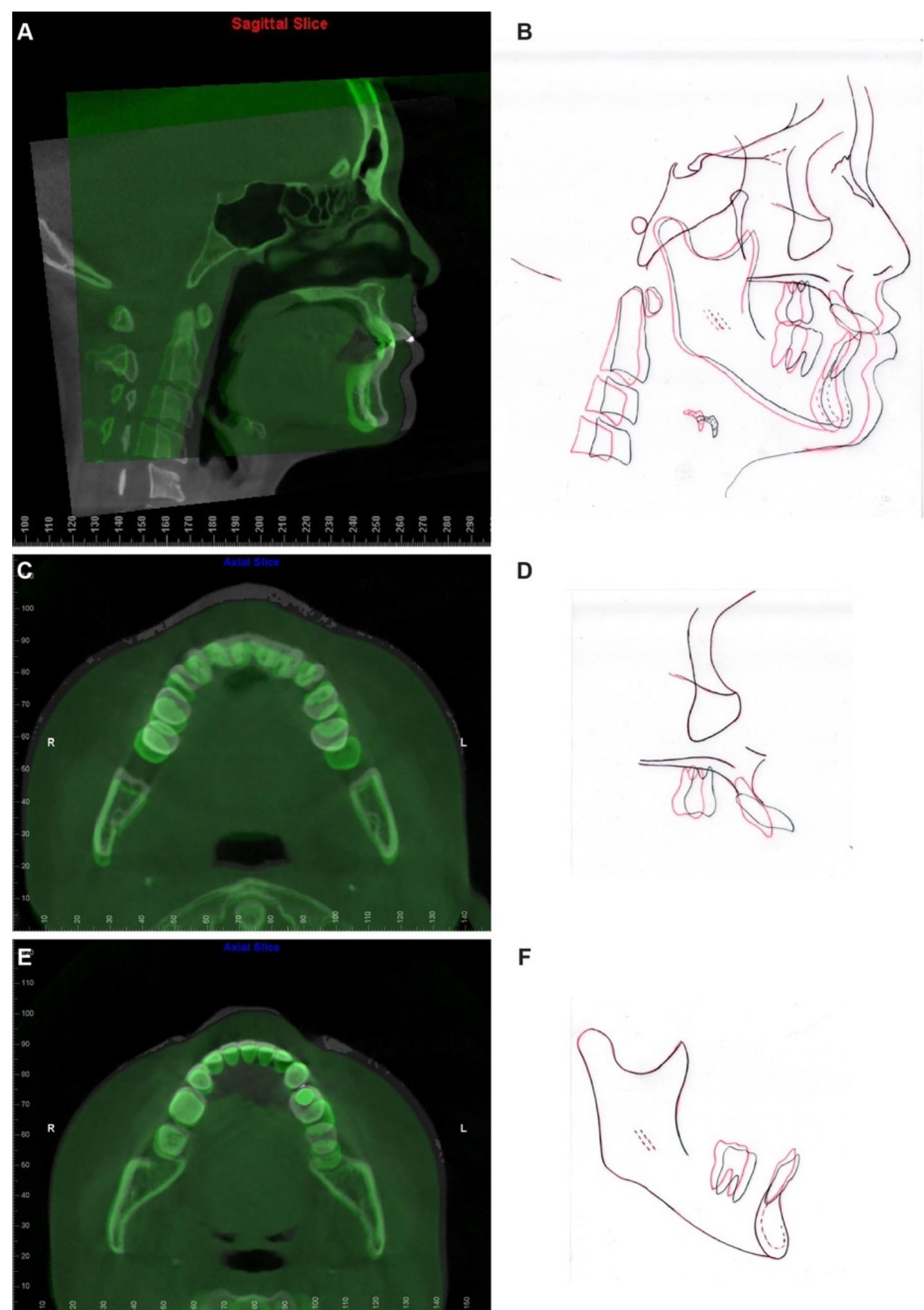 Figure 12 - En-Mass Retraction of Maxillary Anterior Teeth