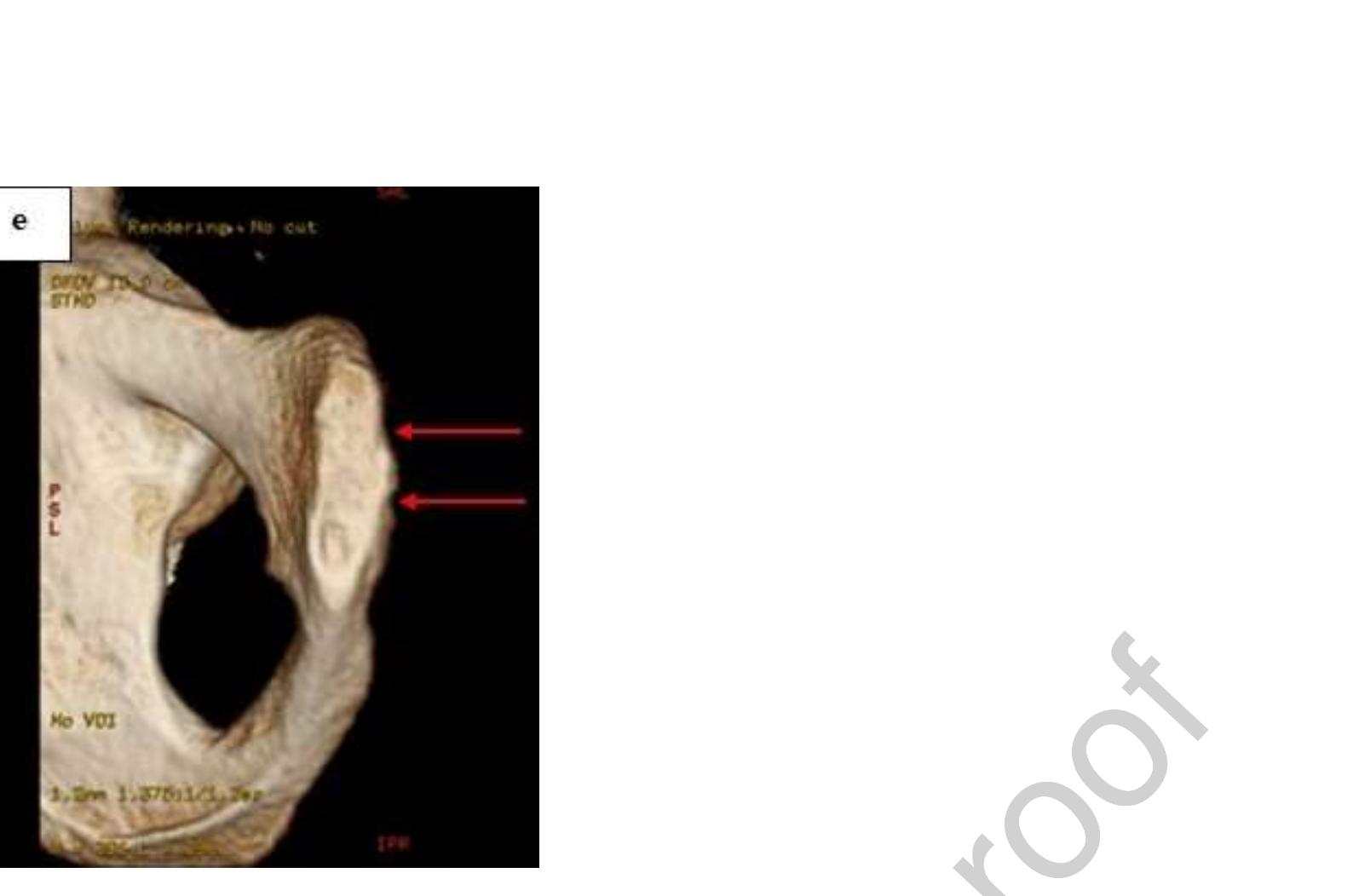 (a-e): 3d reconstructed ct scan images of pubic bone, medial