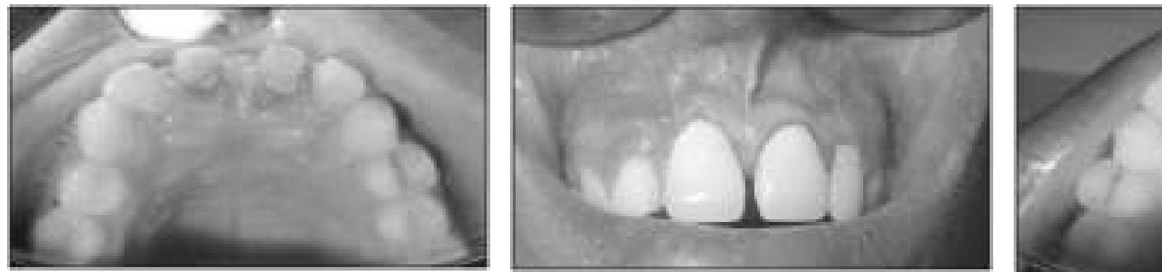 Figure 2 - from Crown Lengthening By Apically Displaced Flap