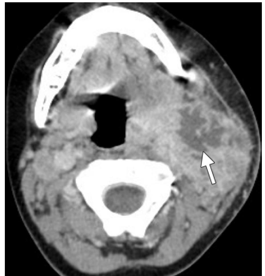 Abscess. contrast-enhanced ct scan at the level of c1 shows