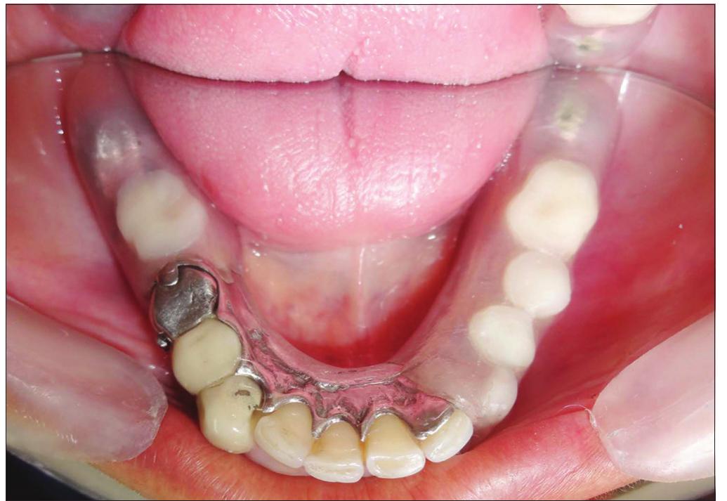 Occlusal view of implant supported removable partial denture