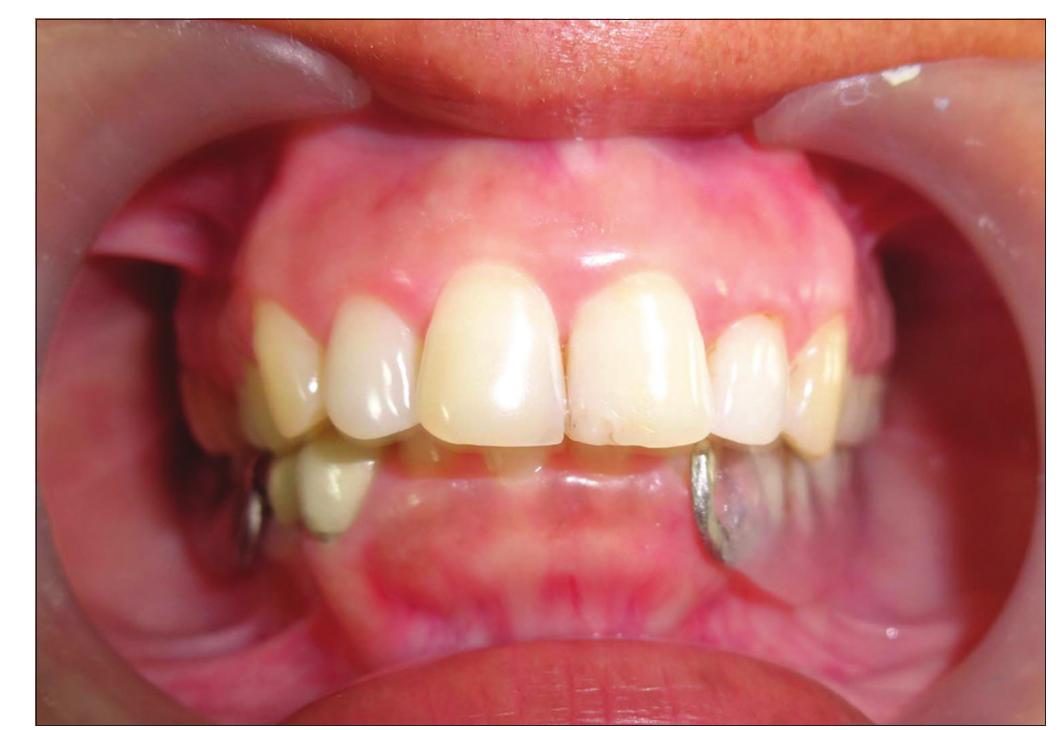 Maxillary and mandibular arch at occlusion figure 4: try-in