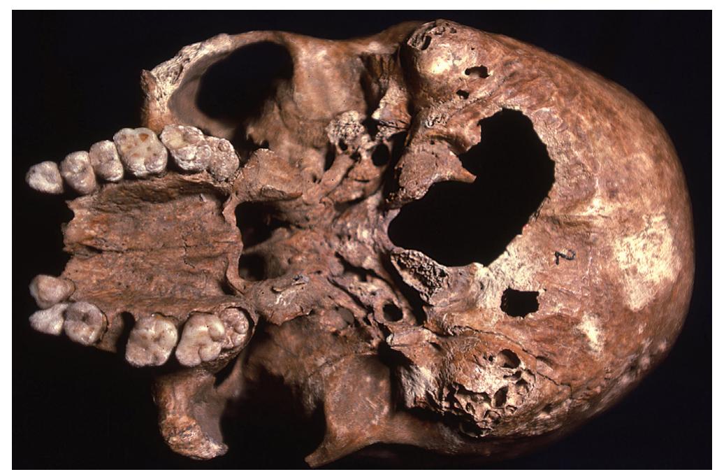 Base of cranium, romito 2. note basocranial compression,