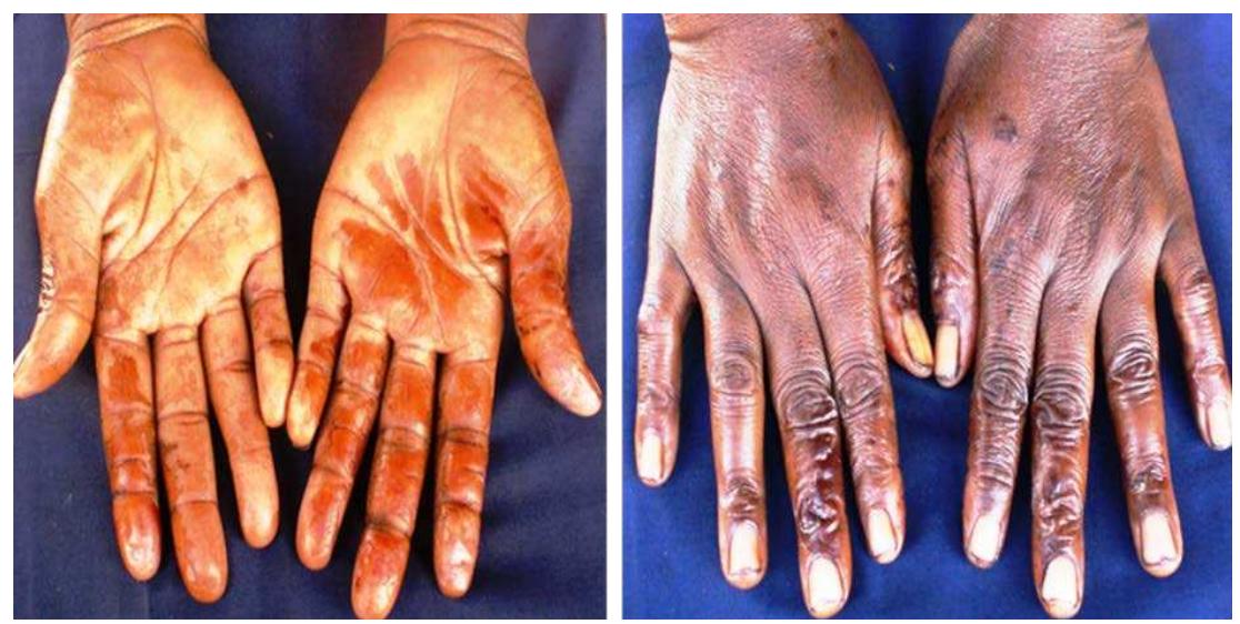 Figure 1 - from Skin Damage and Aesthetic Disadvantage