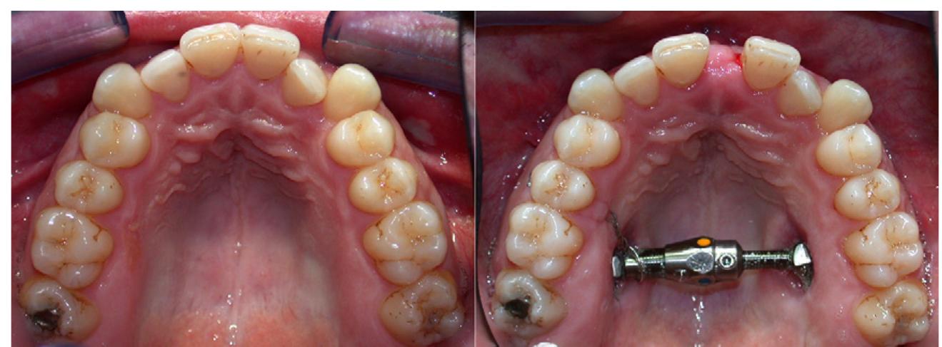 Intra-oral view of the maxillary arch at the beginning