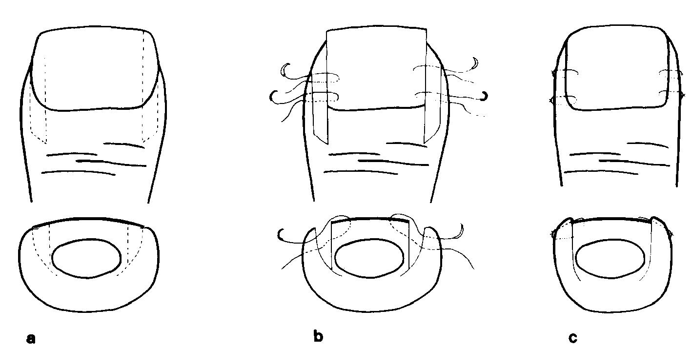Reconstruction of the lateral nail fold for the correction