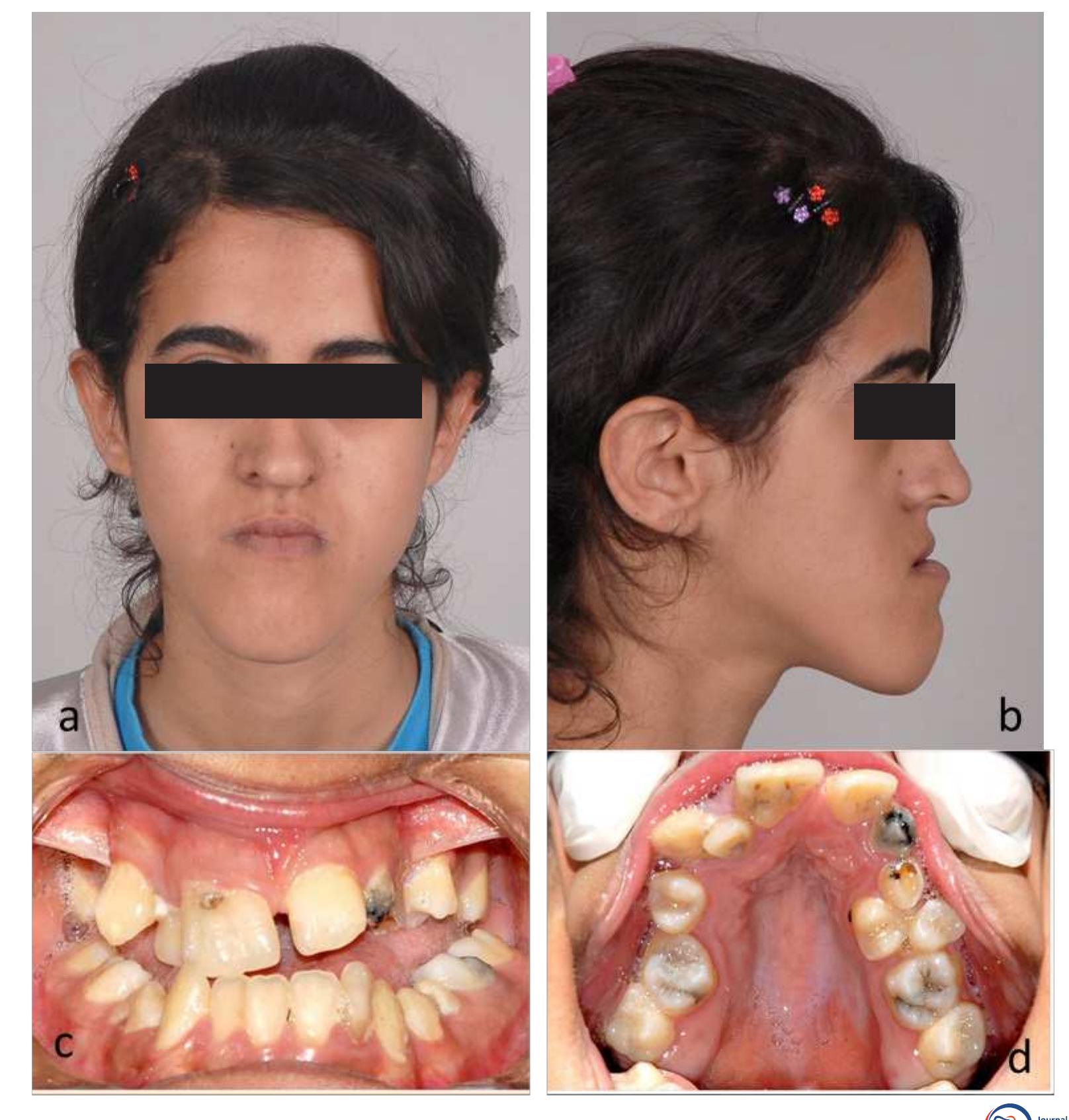 Frontal and lateral view showing facial deformities (a, b),