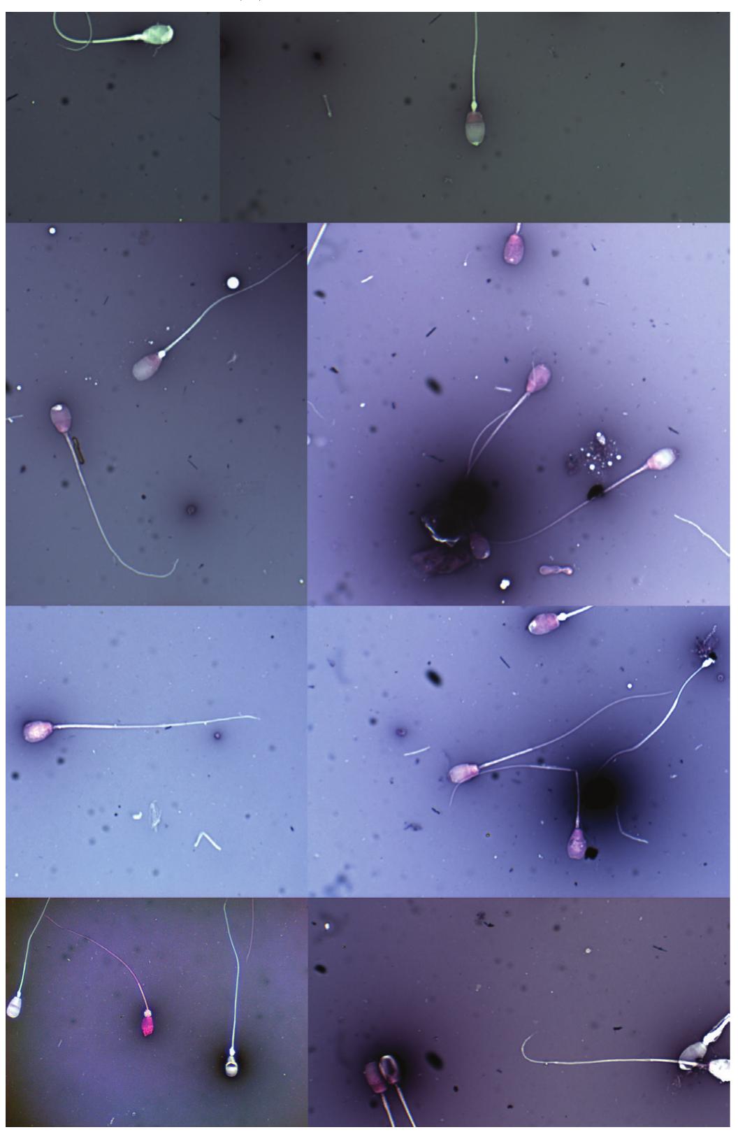 Morphological abnormalities of the sperm head