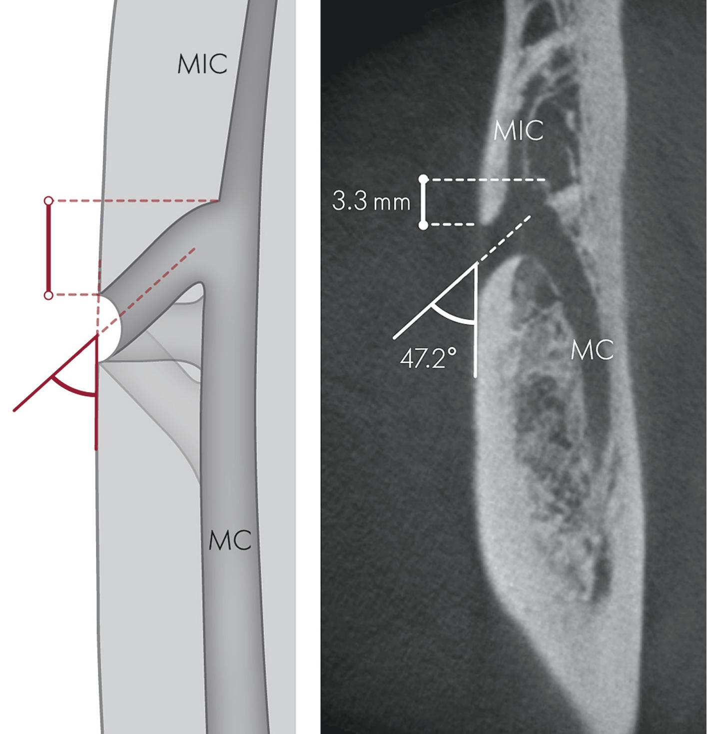 Schematic and radiographic illustrations demonstrating