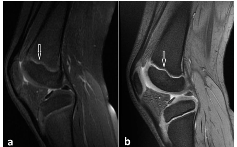 Distal femoral and proximal tibial epiphysis; (a): fast