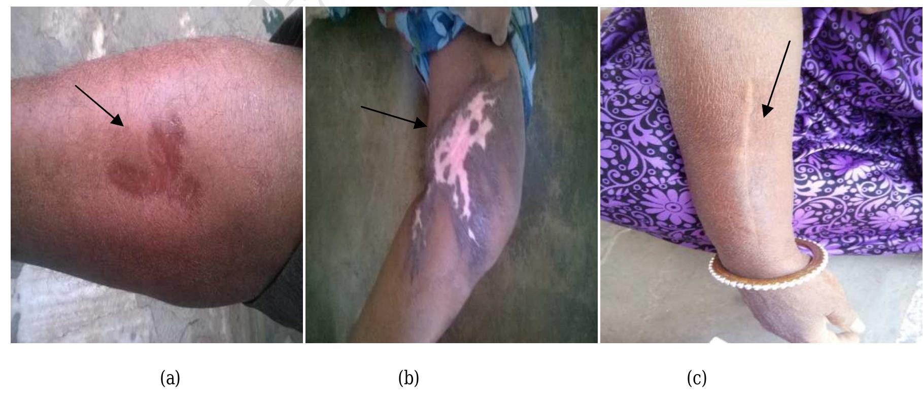 Types of scars: (a) accidental mark, (b) bun injury, (c)