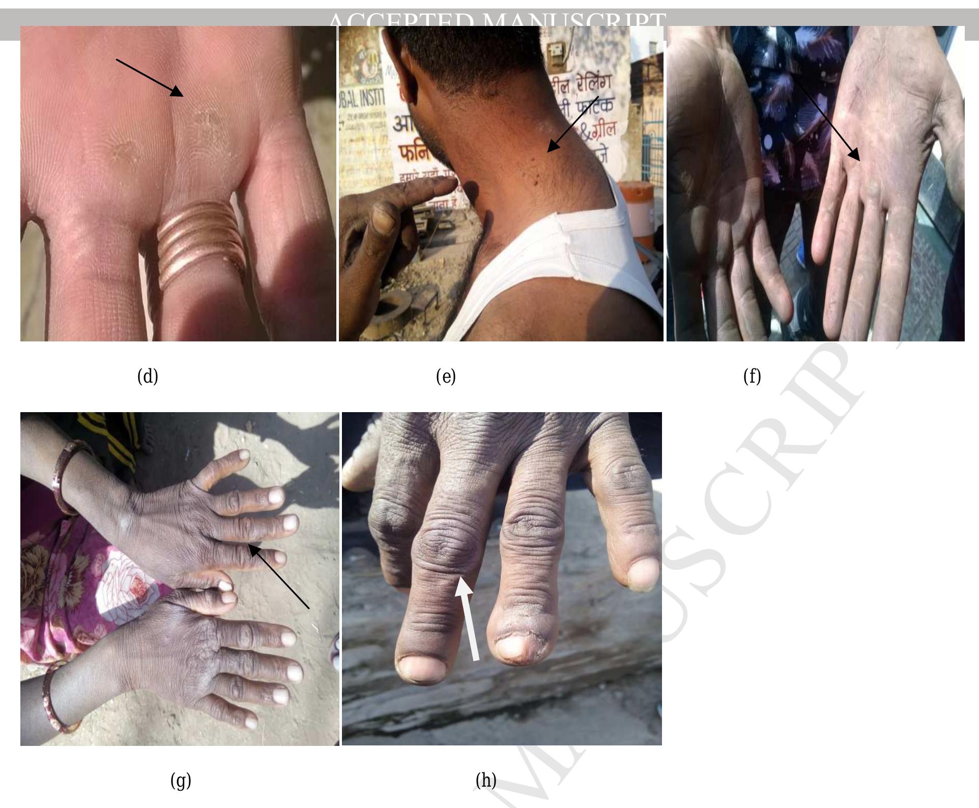 Figure 4 - from Acquired body marks: A mode of