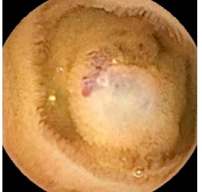 Figure 1 - from Blue rubber bleb nevus syndrome: combined
