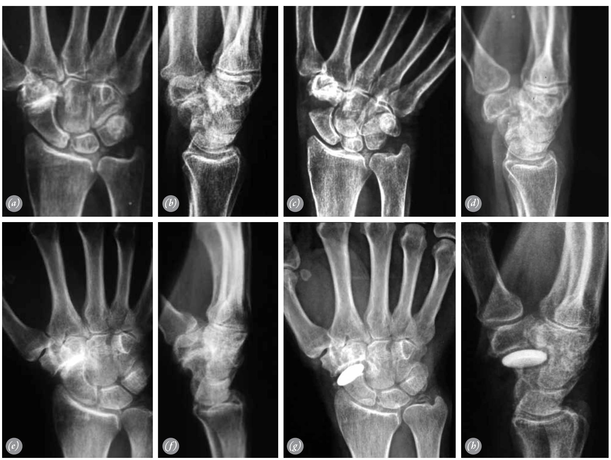 (a) preoperative posteroanterior and (b) lateral views of a