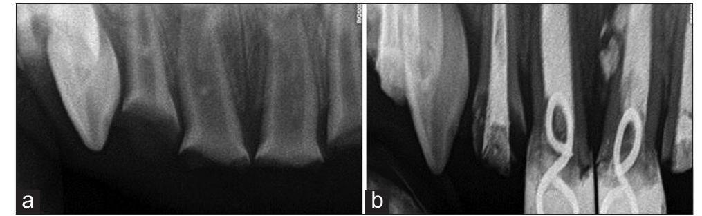 (a) pre-operative intraoral periapical (iopa) radiograph