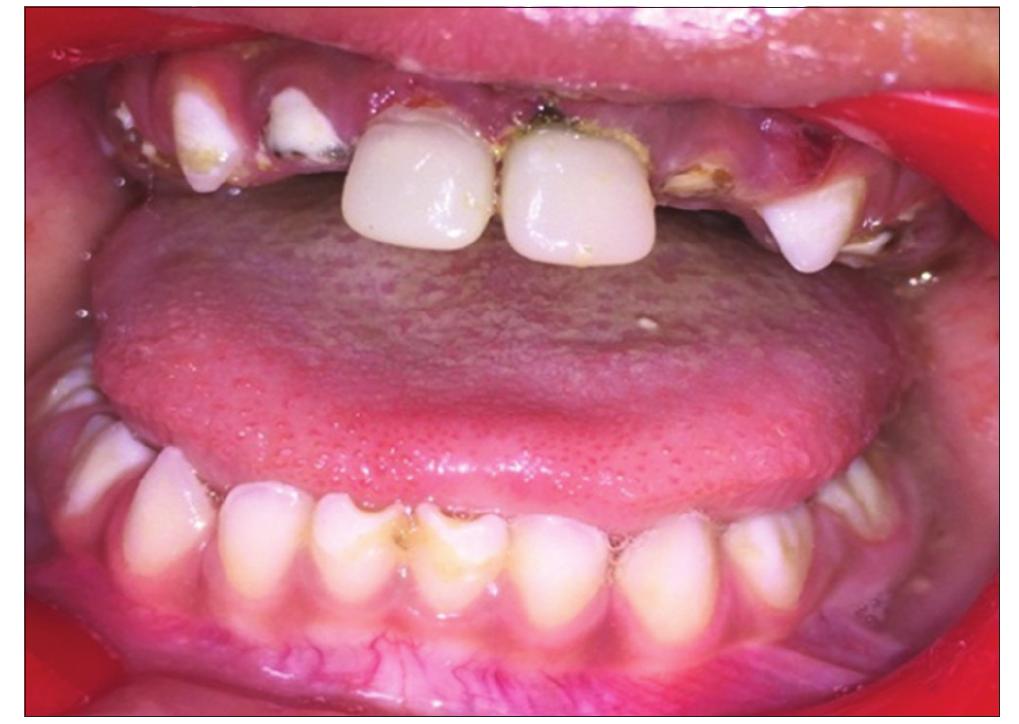 Intraoral frontal view showing final restoration using strip