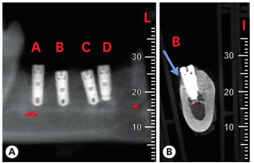 X-ray tomography at 3 months (s100%, intact socket). (a)