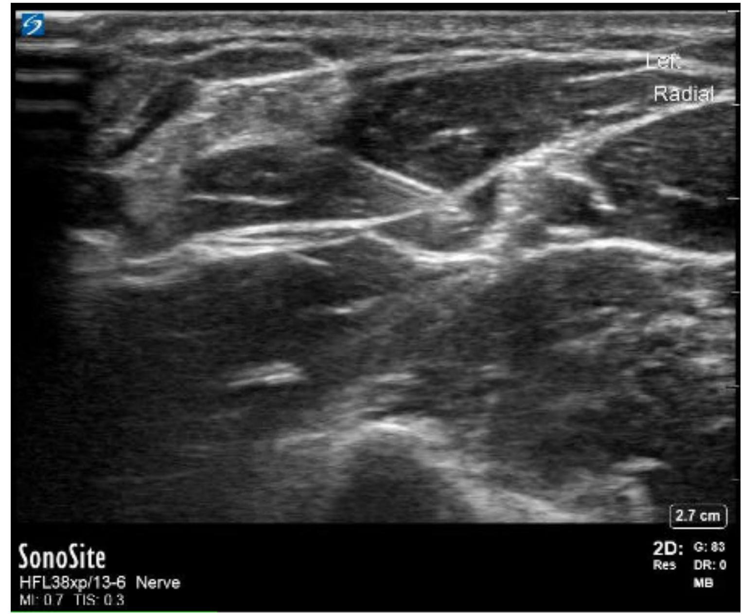 More proximal injuries of the upper extremity require ra