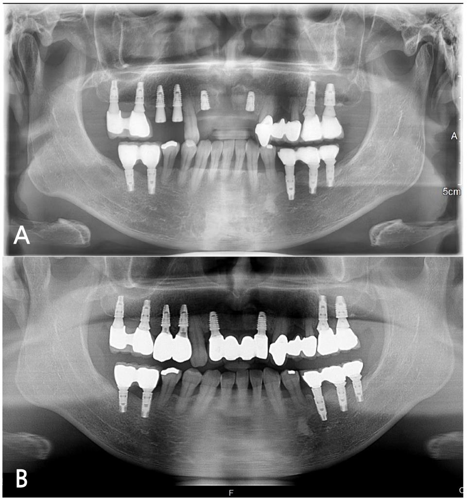 Case 1: panoramic radiograph after implant placement. (a)