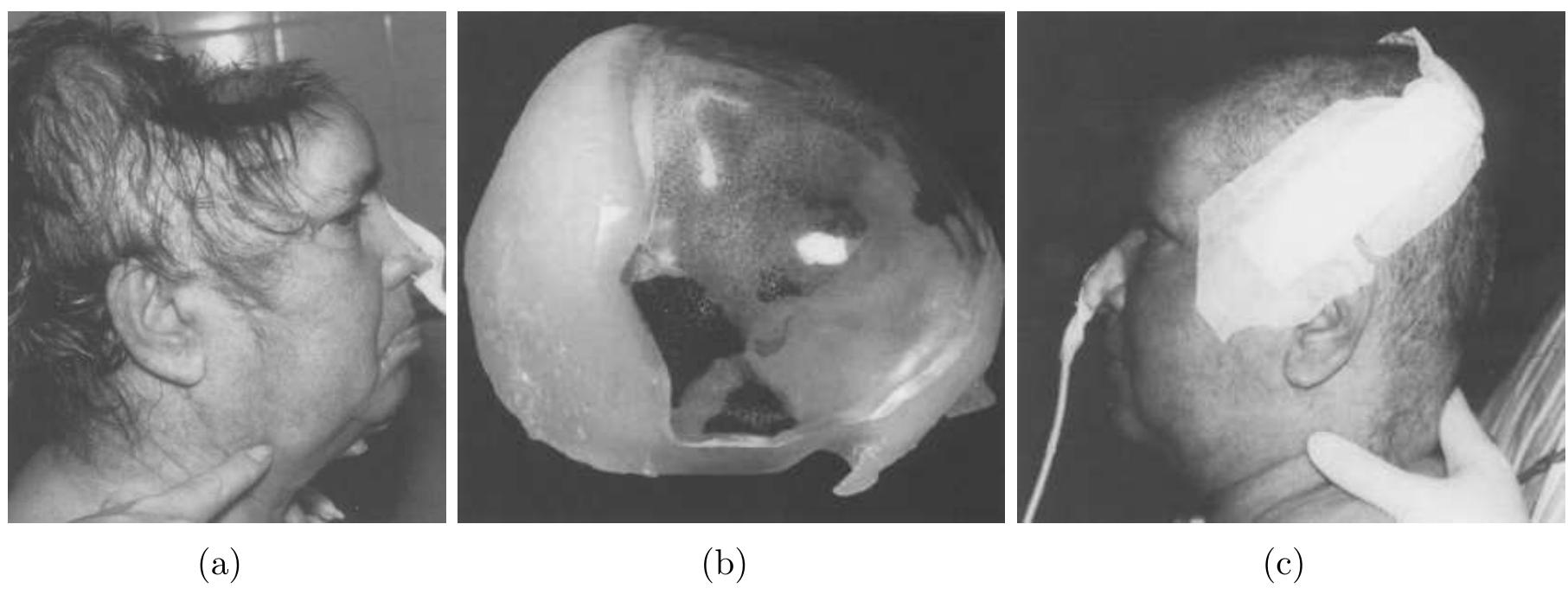 1: (a) patient with a cranial defect; (b) model of skull