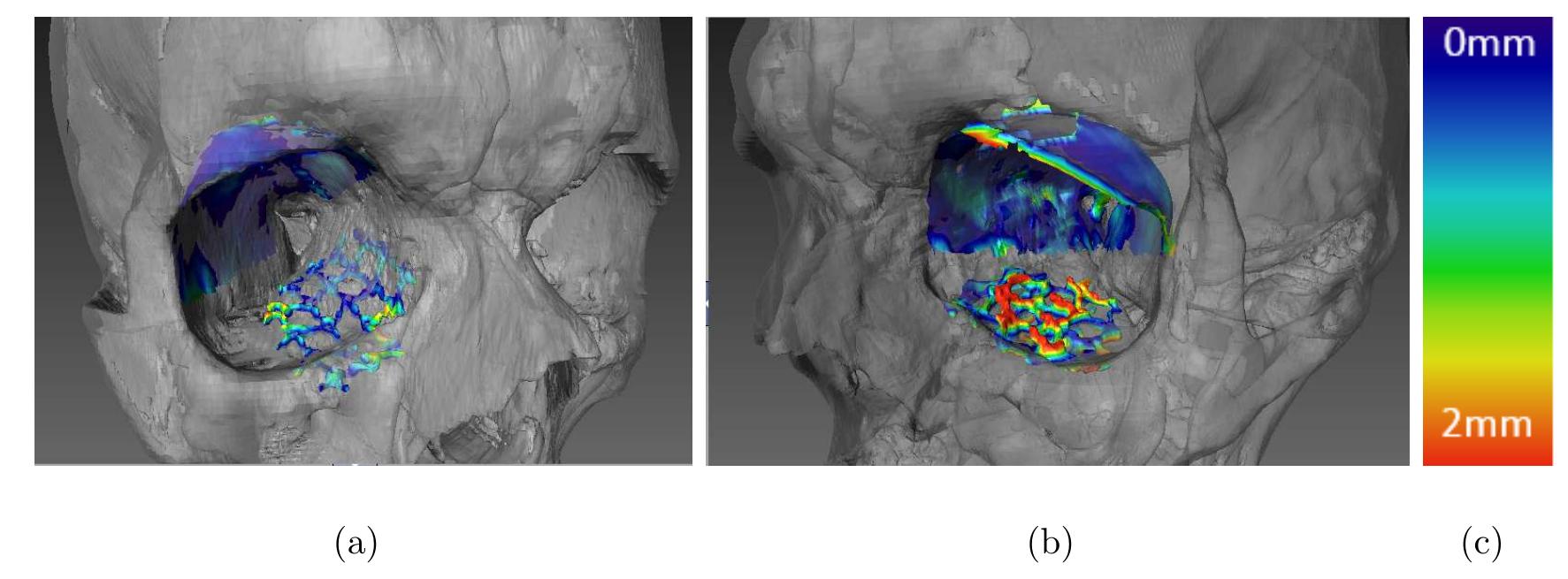 1: post-operative patient skull models displaying distance