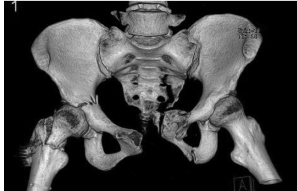 A: 3d computed tomography (ct imaging) revealed right