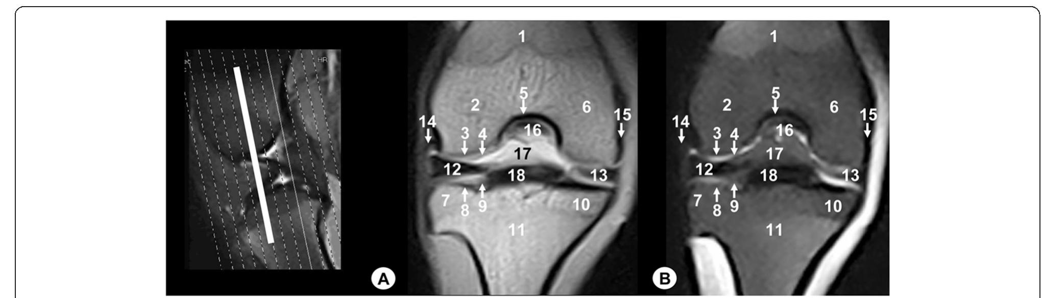 Dorsal mr images of stifle joint. cranial view. line depicts