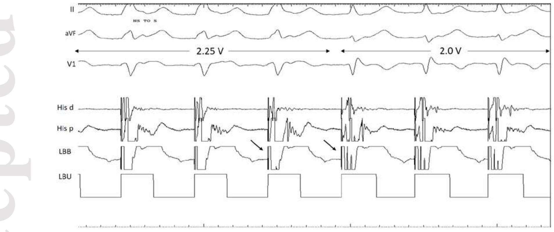 Figure 7 - Left bundle branch pacing: A comprehensive review