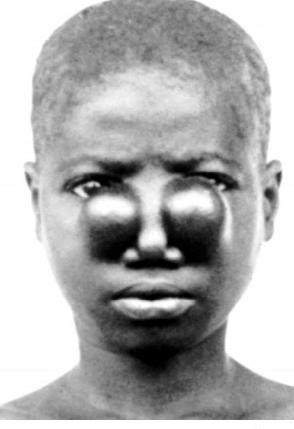 (PDF) Goundou: a historical form of yaws