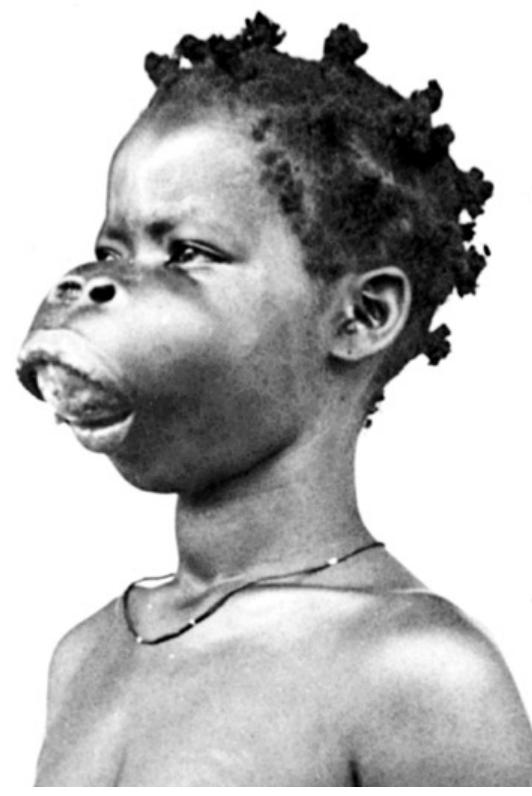 (PDF) Goundou: a historical form of yaws