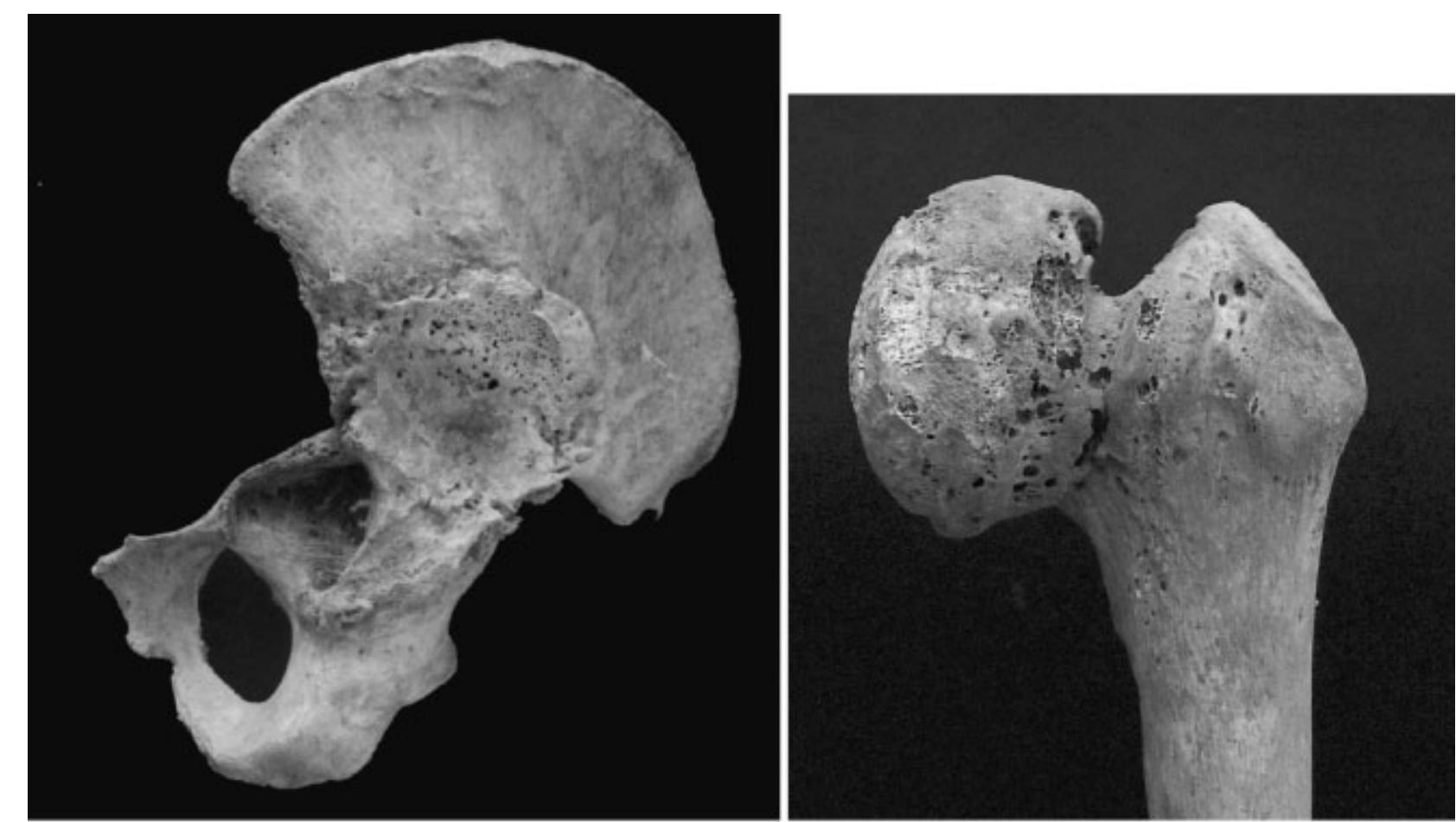 Dislocation of the hip, coxal bone and femoral head, old
