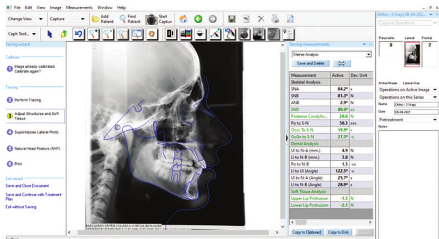 Digital cephalometric tracing using nemoceph software